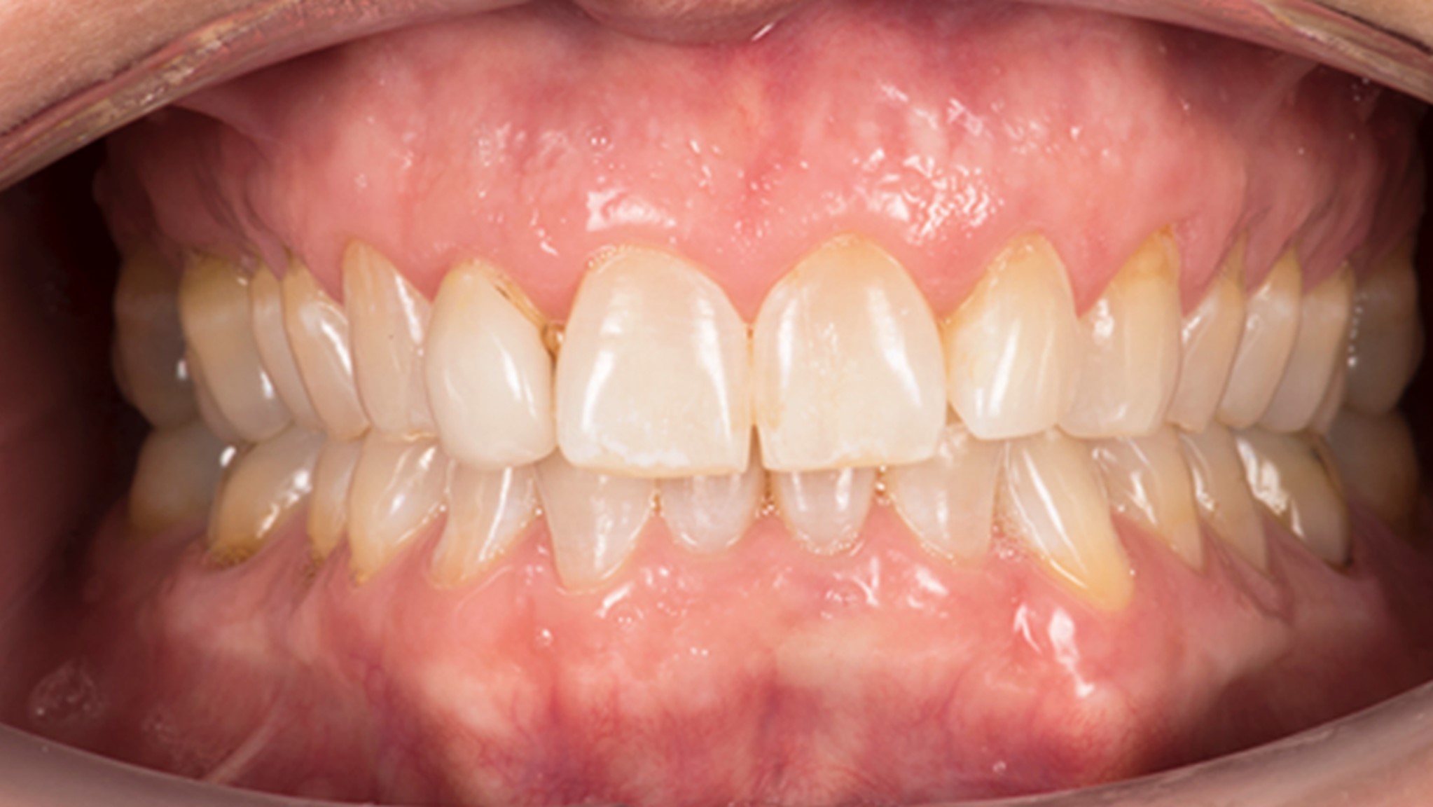 Mild Class II – Narrow Arches (SureSmile® Aligners) UK