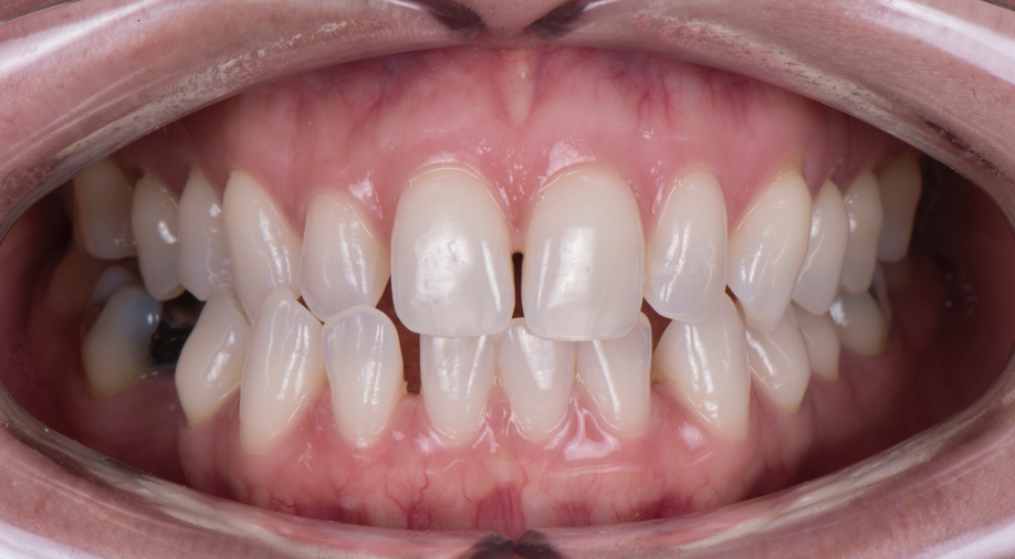 Mild Class 3 Malocclusion: SureSmile Case Study | Dentsply Sirona UK