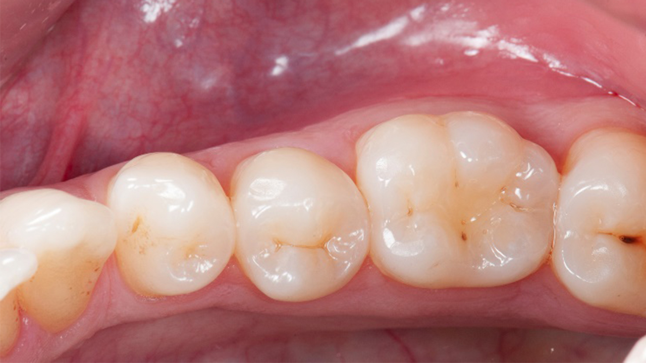 Replacing Class II with Recurrent Caries | Dentsply Sirona MENA