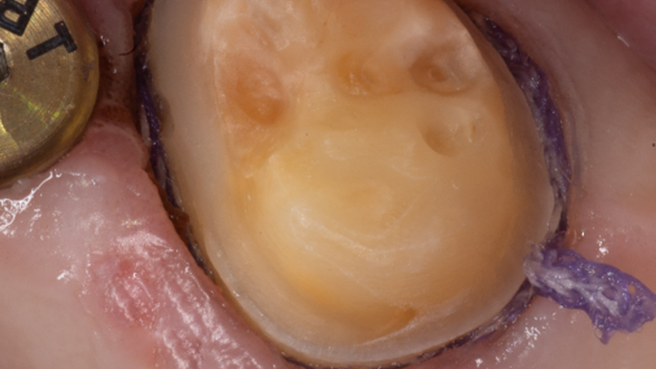 Single-Unit Crown Tissue Management | Dentsply Sirona Ireland