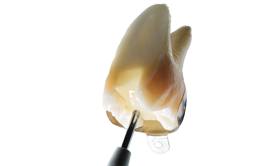 SDR Plus: Bulk Fill Flowable Compositae | Dentsply Sirona India