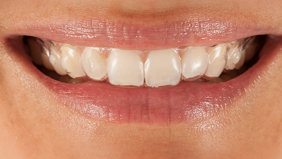 SureSmile Attachment Bonding with TPH Spectra® ST | Dentsply Sirona USA