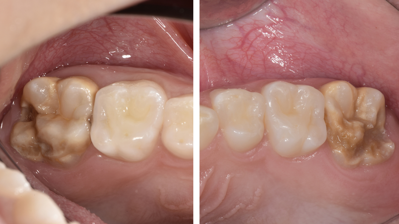 MIH Teeth Treatment: CEREC Tessera Restoration | Dentsply Sirona USA