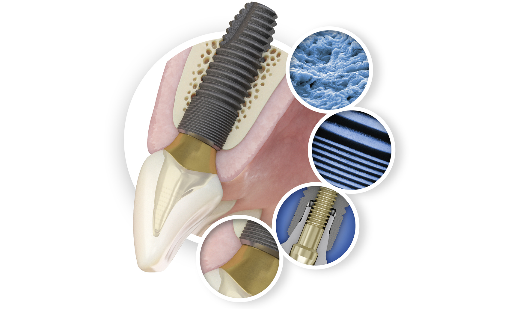 Dental Implant Systems | Dentsply Sirona USA